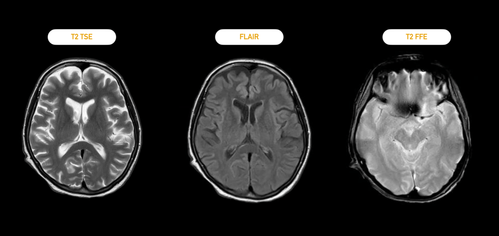 Neuroradiologie 101: MRT für Neurologen – brainpainblog